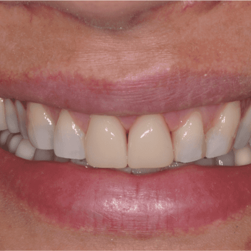 Columbia MD Cosmetic Dentistry Before & After Photos